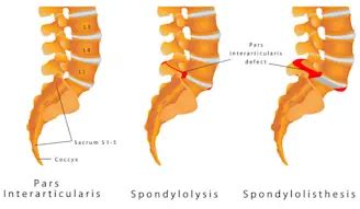 Retrolisthesis C3 C4