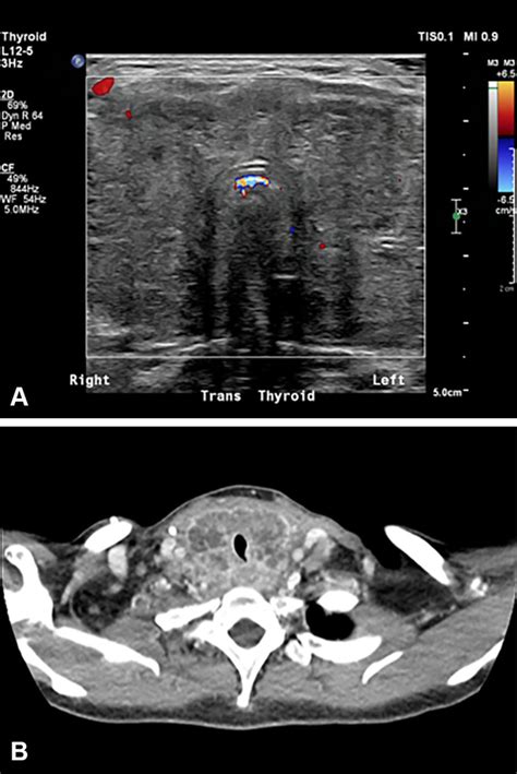 Gastric Cancer Metastasis Mimicking Thyroiditis Pmc