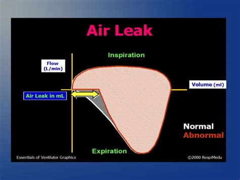 Ventilator Waveforms Dr Sanjay Chugh Pptx Lung And Respiratory Health