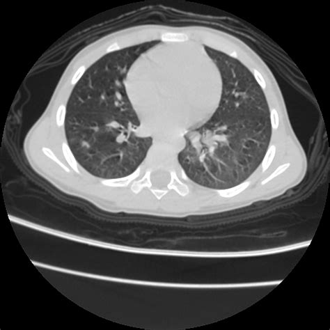 Bronchiolitis Pacs