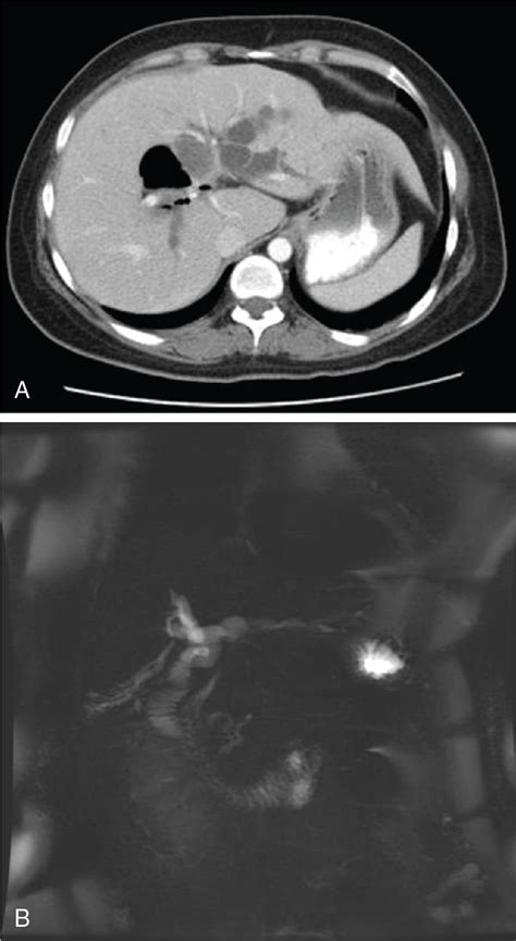 Bile Duct Cysts In Adults Clinical Tree