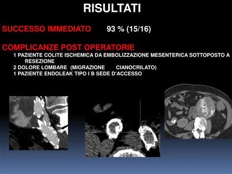 Ppt Transealing Nuova Tecnica Per Il Trattamento Degli Endoleak Tipo Ii Powerpoint
