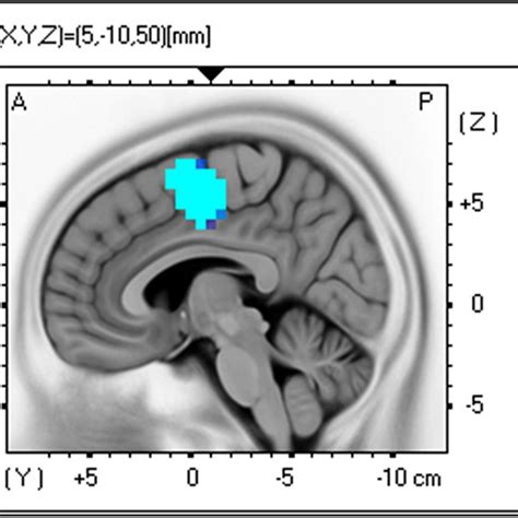 Graphic Depiction Of Cluster Activation In Medial Frontal Cortex As