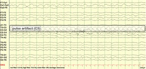 Eye Flutter Eeg At George Bousquet Blog