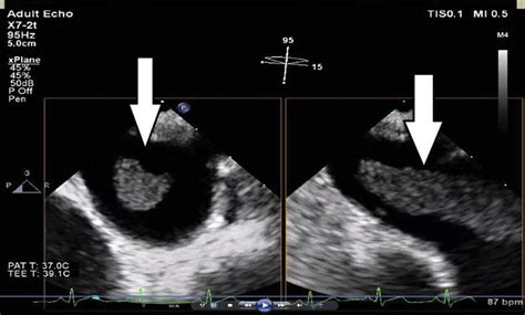 Tee Still Image Using X Plane Showing Echodensity Within The Transverse