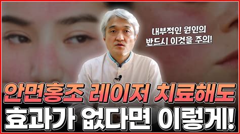 안면홍조 레이저 치료해도 효과가 없는 경우 꼭 시청하세요 ｜안면홍조없애는법 안면홍조 원인 안면홍조 완치 안면홍조 한의원 Youtube