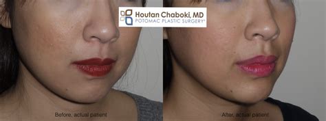 How To Reduce Swelling After Lip Injections And Botox®
