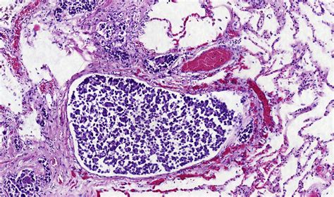 He Micro Thrombus Within Pulmonary Vasculature Lymphangitic Pulmonary