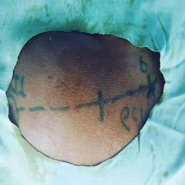 Landmark For Sacral Plexus Block Download Scientific Diagram