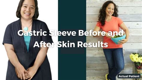 Gastric Sleeve Before And After Skin At Levi Irvine Blog