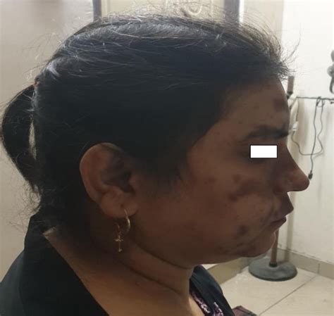 Picture Showing The Cervical Lymphnodal Swelling Download Scientific Diagram