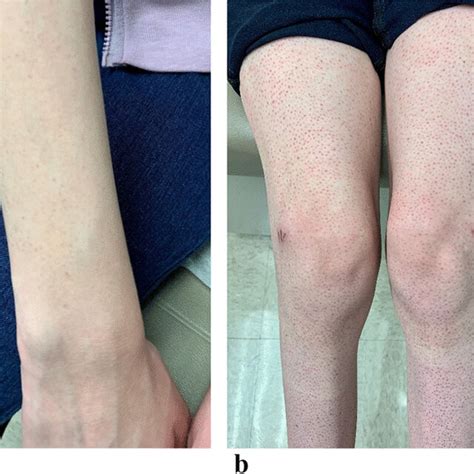 Photos Of The Patients Perifollicular Petechial Hemorrhagic Rash With