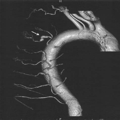 Pdf Coil Embolization For Ruptured Intercostal Artery Aneurysm