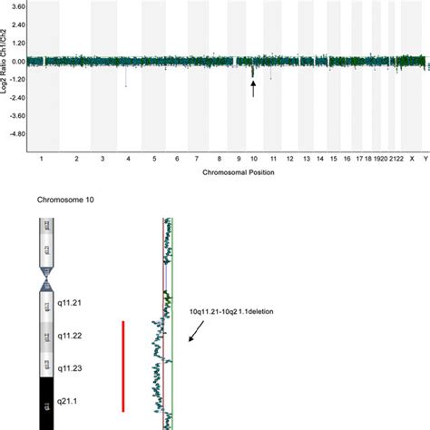 Pdf Prenatal Diagnosis Of An Interstitial Deletion Of 10q 10q11 21 Q21 1 Array