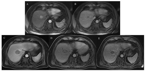 Combination Therapy Of Bland Transarterial Embolization And Microwave Ablation For