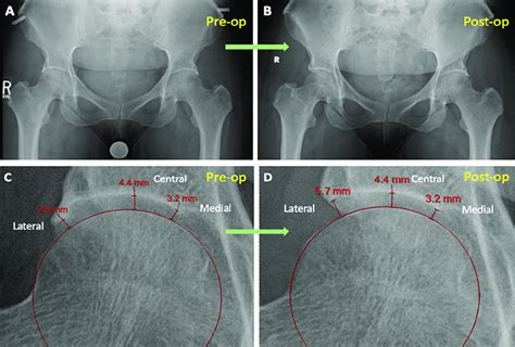 A Preoperative And B 2 Week Postoperative Supine Ap Pelvis Download Scientific Diagram