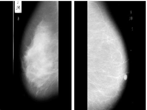Unlike Most Mlo View Mammograms Figure 1 The Pectoral Muscle Is