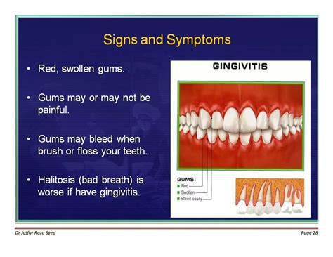 Gingivitis Pdf