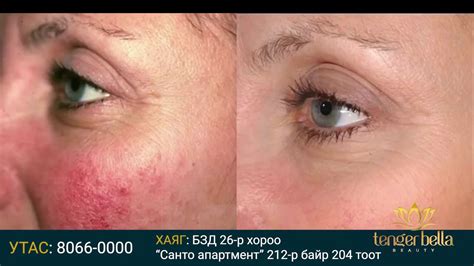 Хацрын улаан судас арилгах Хамгийн сүүлийн үеийн тэвшилтэт технологийн