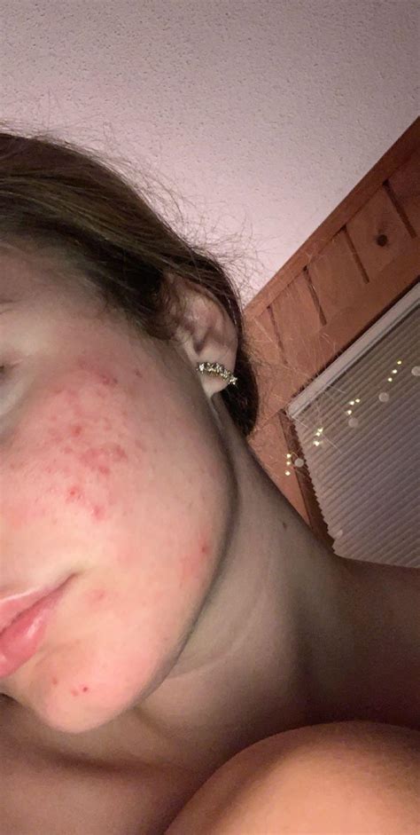 Ive Recently Began To Develop Weird Texture Bumps On My Skin Idk Where To Even Start To Treat