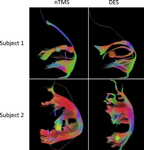 Frontiers Preoperative Individual Target Transcranial Magnetic Stimulation Demonstrates An