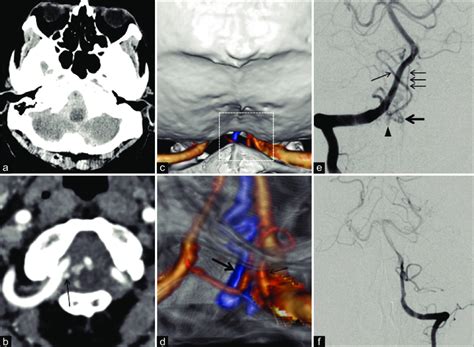 Computed Tomography Shows Subarachnoid Hemorrhage In The Posterior Download Scientific Diagram