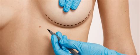 Breast Fat Transfer In Dubai Vs Implants Whats Best