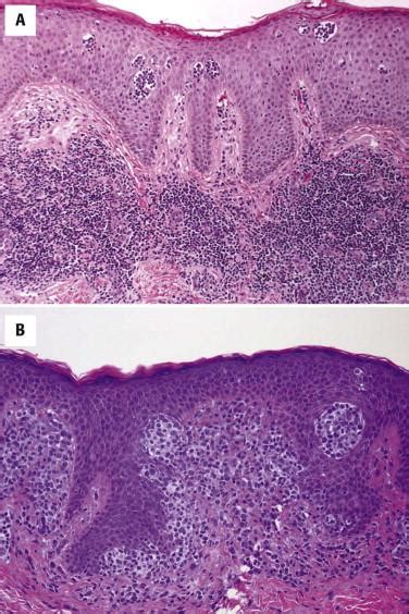 Hematopoietic Neoplasms Clinical Tree