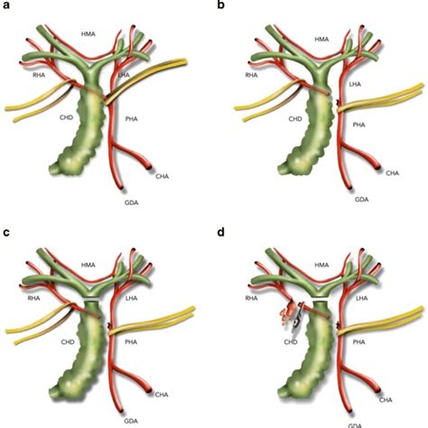 Hepatic Artery Resection Without Reconstruction In Pancreatoduodenectomy Request Pdf