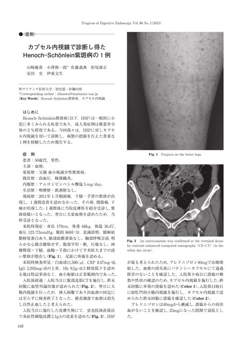 Pdf A Case Of An Ulcer Of The Terminal Ileum Caused By Henoch Schönlein Purpura Evaluated By