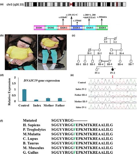 Novel Homozygous Pathogenic Mitochondrial Dnajc19 Variant In A Patient With Dilated