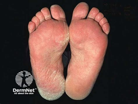 Tinea Pedis Skin Peelings Typical Of Fungi Tinea Pedis Tinea