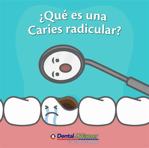 La Caries Radicular Es Dental Jwarner Real Del Bosque