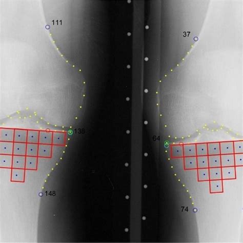knee trabecular bone mapping using bone finder software for roi