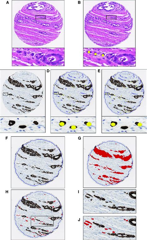 Methods Of Assessment Of Tumour Budding A E Manual Methods F J