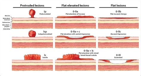 Paris Classification Of Gastric Polyps Dr Matt W Johnson Bsc Mbbs Frcp Md