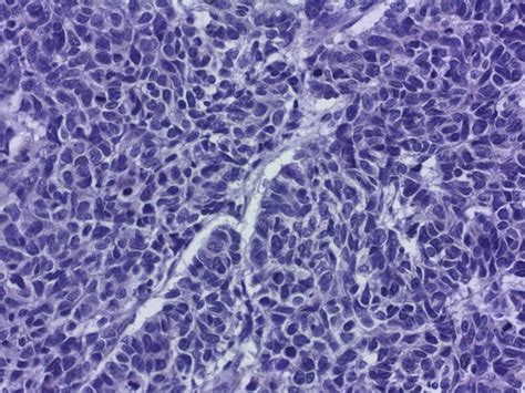 Absence Of Hla G Molecule Expression In Tumoral Tissue From Patients