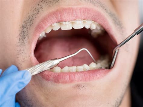 Gingivectomy Joseph Barclay