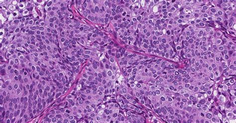 Health Lines Cervical Squamous Cell Carcinoma Epidemiology Etiology
