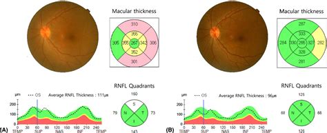 Characteristics Of Retinal Layer Thickness In Acute Anterior Uveitis An Optical Coherence