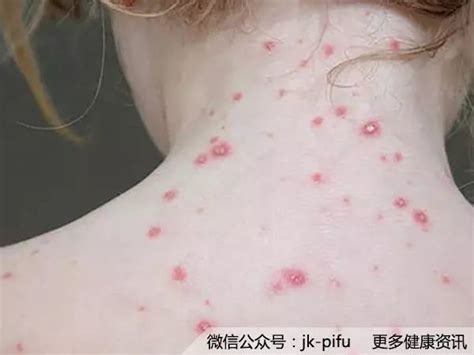 教你应对各种过敏的方法，赞！ 医学界 助力医生临床决策和职业成长