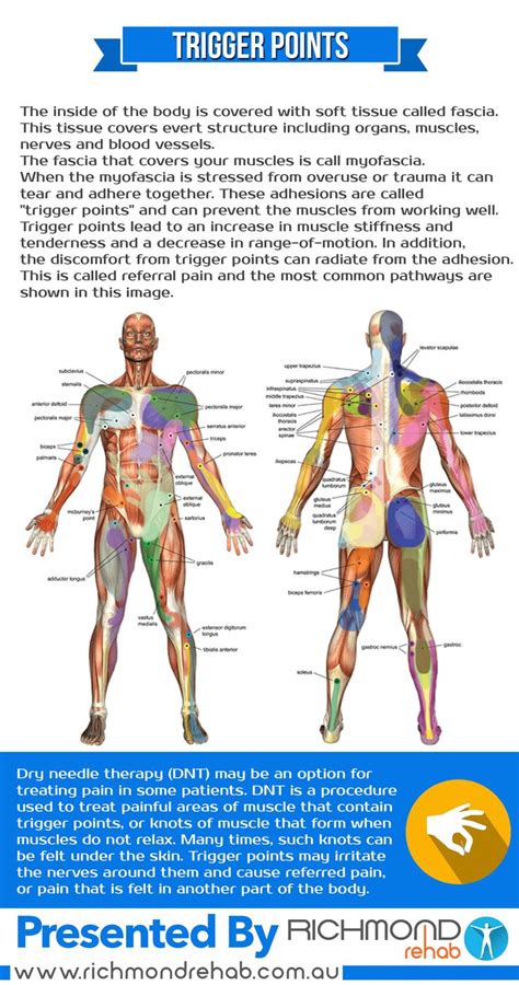 Trigger Points Explained Richmond Rehab Physio Exercise Massage Trigger Points