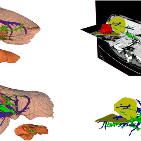 Preoperative Liver Rendering Liver Reconstruction With Layers
