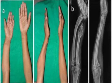 Pre Operative Forearm Deformity A Clinical Image Showing Ulnar