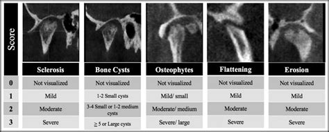 Mandibular Condylar Remodeling Characteristics After Simultaneous