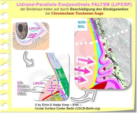Diagnostik Woran Erkenne Ich Ein Trockenes Auge — Ocular Surface
