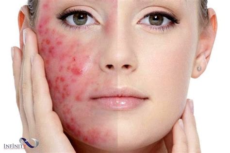 😡Пъпки по лицето как да се отървем от тях Natural Acne Remedies Acne Treatment Products