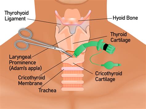Cricothyrotomy Emergency Surgical Airway Interventions And Procedures