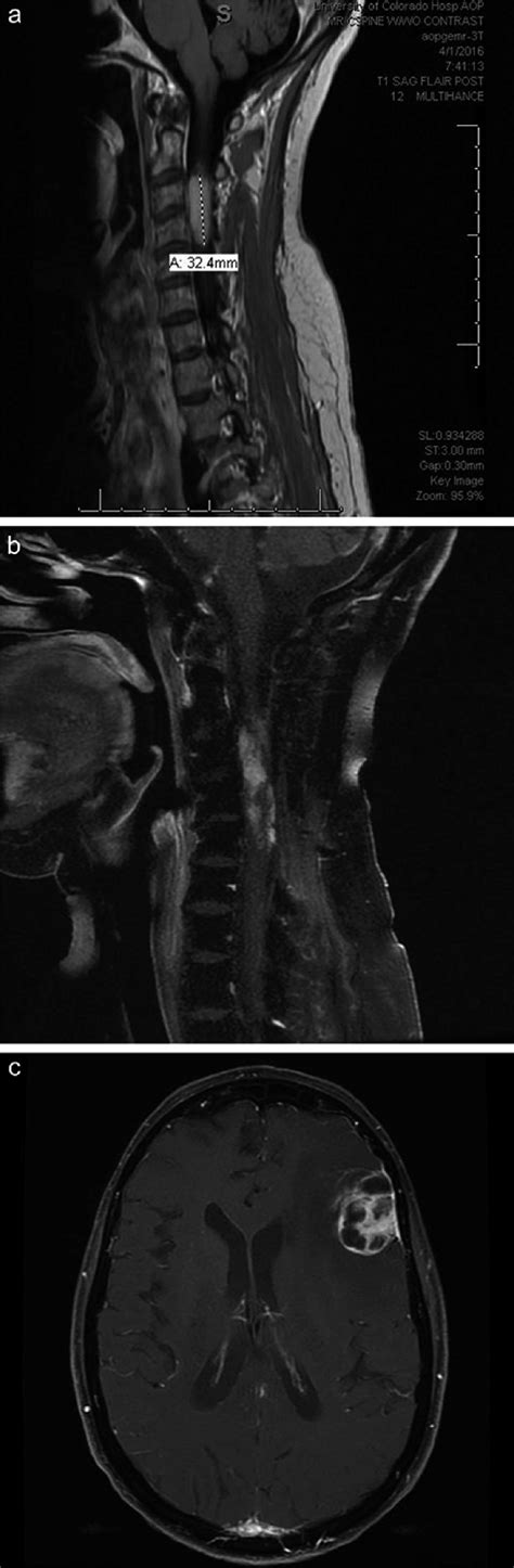 Aggressive Nature Of Diffuse Midline Gliomas With H K M Mutation And Download Scientific