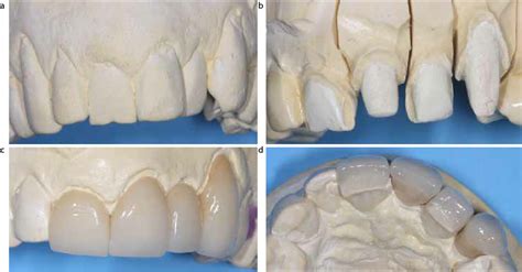 A Mildly Malaligned Teeth The Key Tooth Here Is The Instanding Ul2